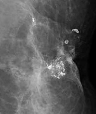 Mammography: Calcifications - Radiology | UCLA Health
