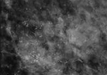 Mammography: Calcifications - Radiology | UCLA Health