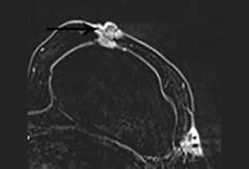 Breast MRI Findings: Post-Surgical Findings - Radiology | UCLA Health