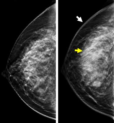 Case: Inflammatory Breast Cancer - Radiology | UCLA Health