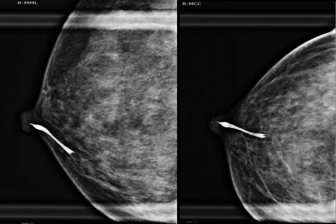 How to Perform: Ductograms - Radiology | UCLA Health