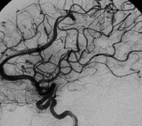 Arteriovenous Malformation - Interventional Neuroradiology | UCLA Health