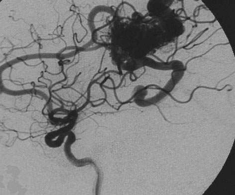 Arteriovenous Malformation - Interventional Neuroradiology | UCLA Health