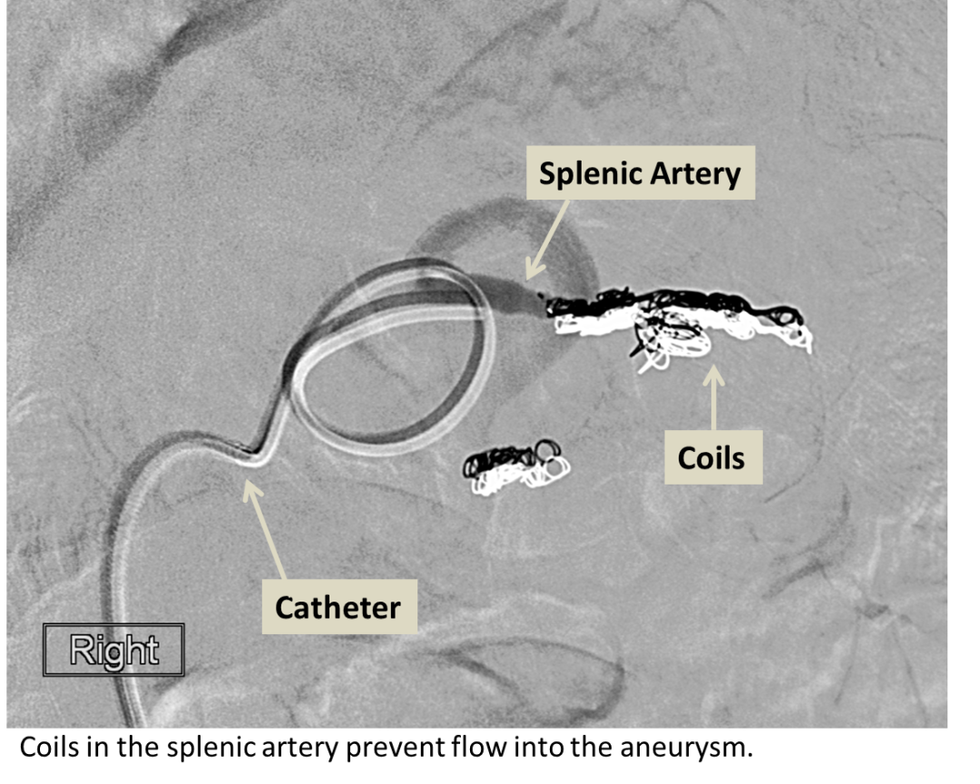 Aneurysm and Dissection - Interventional Radiology | UCLA Health