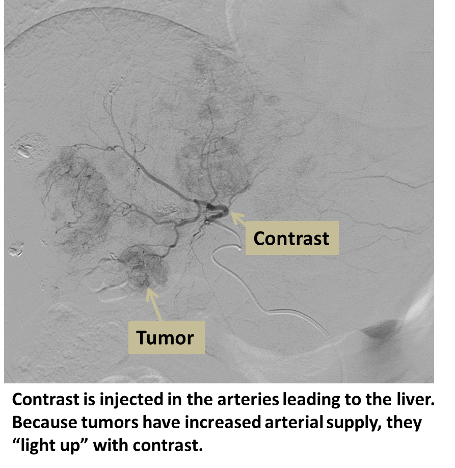 Chemoembolization Liver Cancer Treatment - Interventional Oncology ...