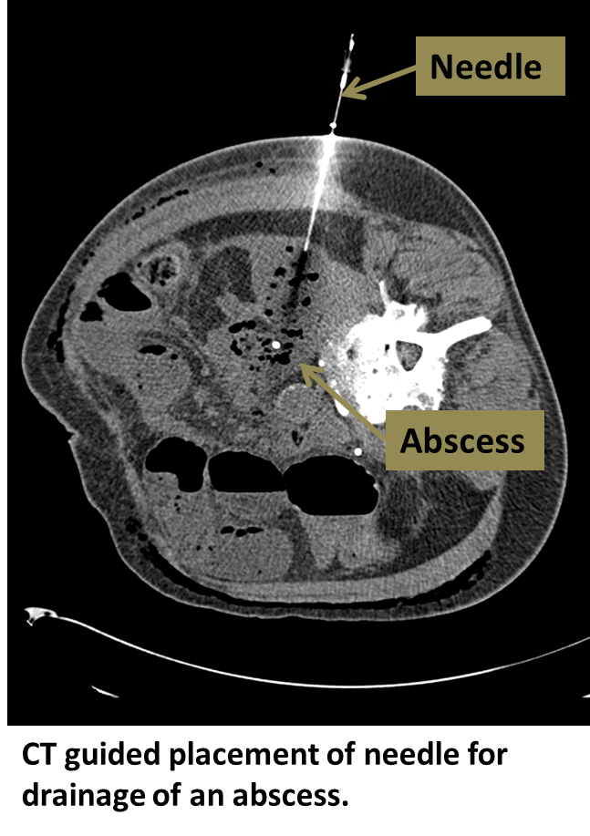 Drainage Percutaneous - Interventional Radiology | UCLA Health