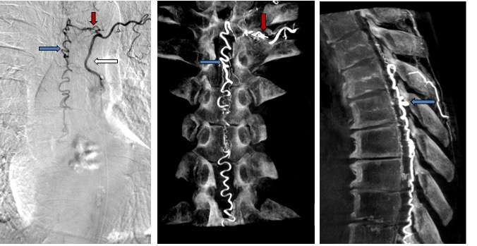 Spinal Vascular Malformations - Cerebrovascular Disease | UCLA Health