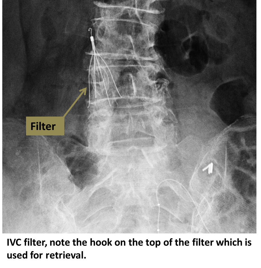 IVC Filter Placement - IVC Filter | UCLA Health