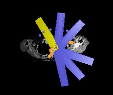 Stereotactic Body Radiation Therapy (SBRT) - Radiation Oncology | UCLA ...
