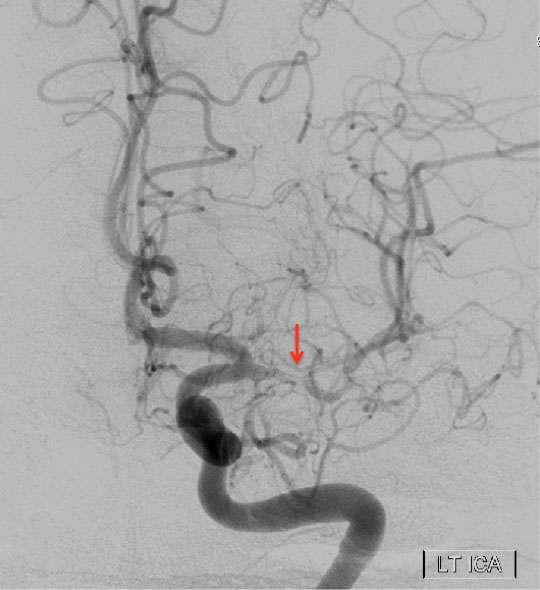 Intracranial Arterial Stenosis - Interventional Neuroradiology | UCLA ...