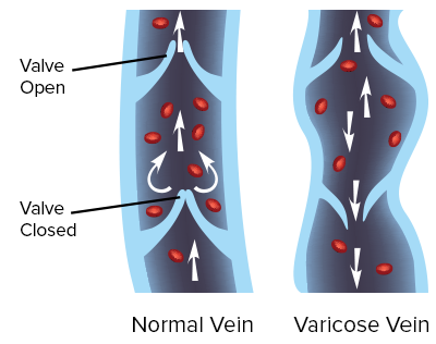 Varicose Veins - Venous Care | UCLA Health