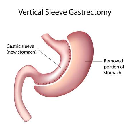 Gastric Sleeve, Sleeve Gastrectomy, VSG (Vertical Sleeve Gastrectomy ...