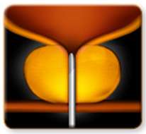 UroLift Procedure for BPH - Urology | UCLA Health