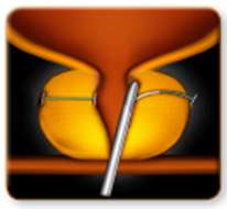 UroLift Procedure for BPH - Urology | UCLA Health