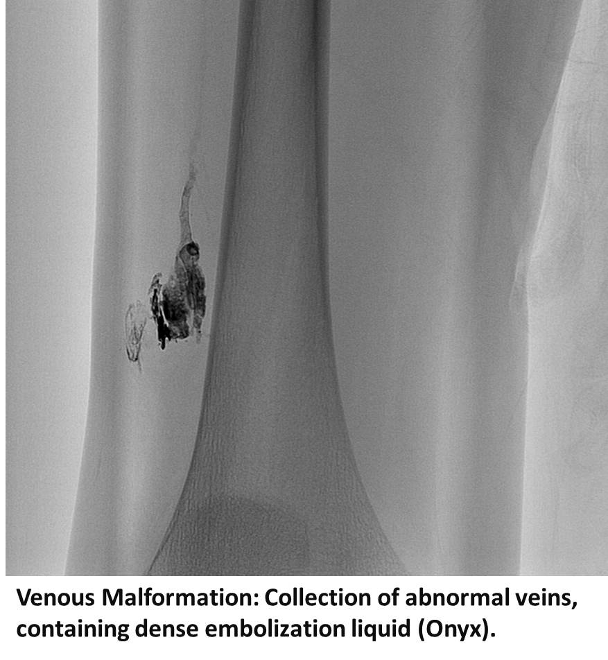 Venous and Lymphatic Malformations - Interventional Radiology | UCLA Health