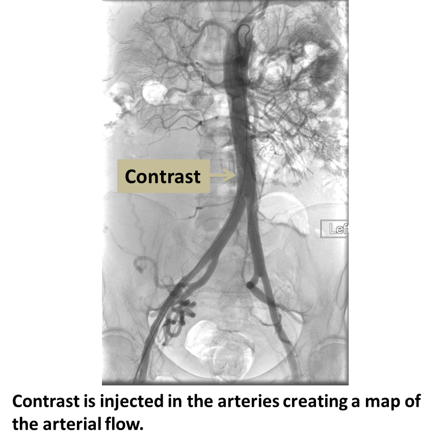 Angiography - Interventional Radiology | UCLA Health