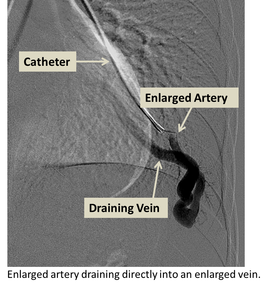 Pulmonary Arteriovenous Malformations (AVM) - Interventional Radiology ...