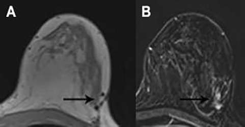 Breast MRI Findings: Post-Surgical Findings - Radiology | UCLA Health