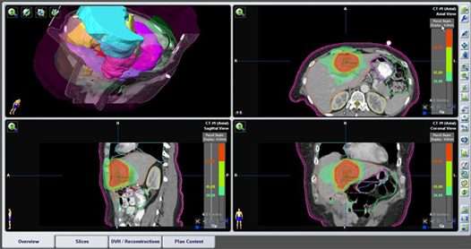 GI Cancers (Rectal, Anal, Pancreas) - Radiation Oncology | UCLA Health ...