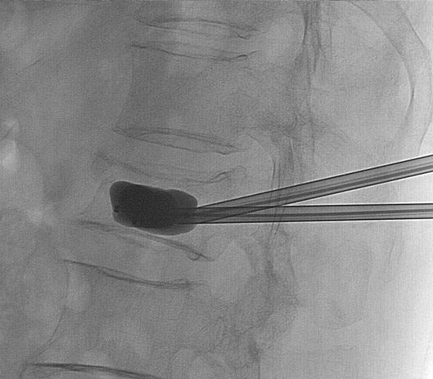 Vertebroplasty / Kyphoplasty / Sacroplasty - Interventional ...