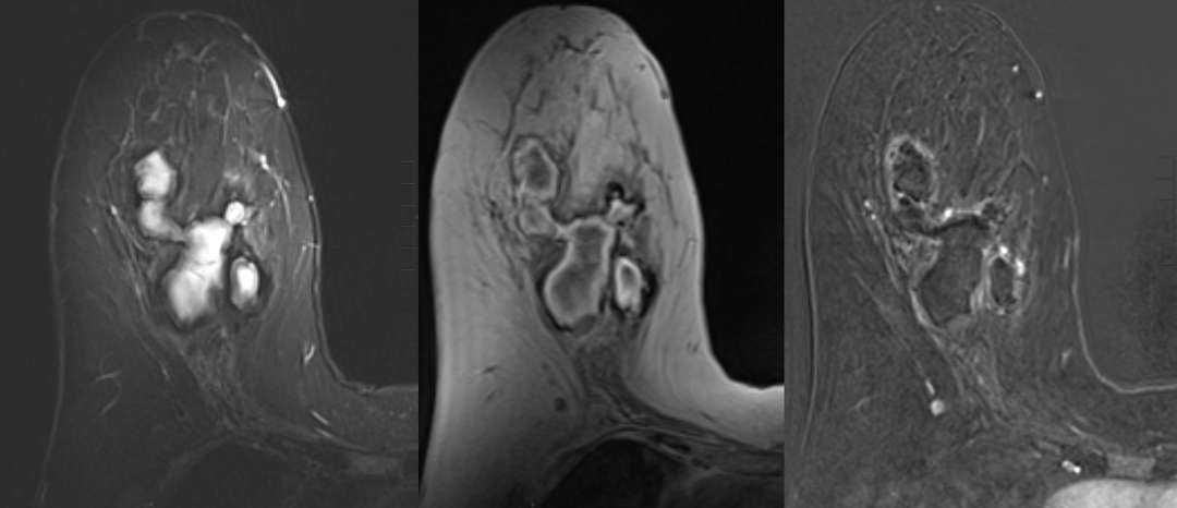 Post-Surgical Fluid Collections: Causes, Symptoms, and Management ...