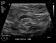 Axillary Lymphadenopathy - Radiology | UCLA Health