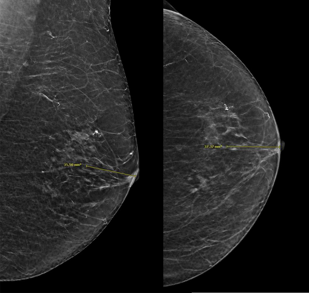 Breast Lesion Localization - Radiology | UCLA Health