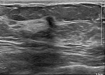 Case: Invasive Lobular Carcinoma - Radiology | UCLA Health