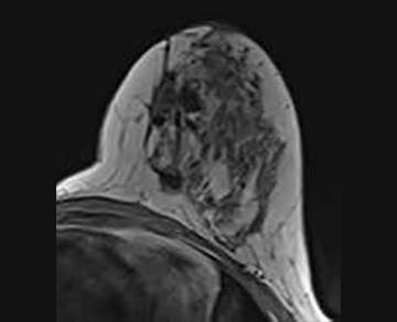 Breast MRI Findings: Post-Surgical Findings - Radiology | UCLA Health