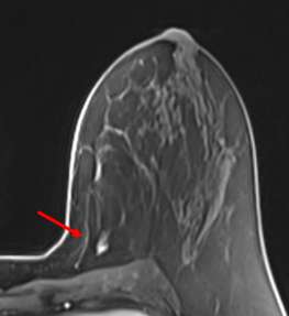 Case: Lobular Carcinoma in Situ (LCIS) - Radiology | UCLA Health
