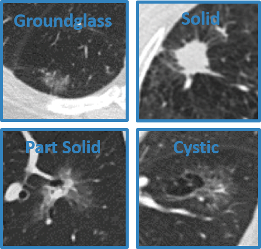 What Happens After a Screen - Lung Cancer | UCLA Health Jonsson ...