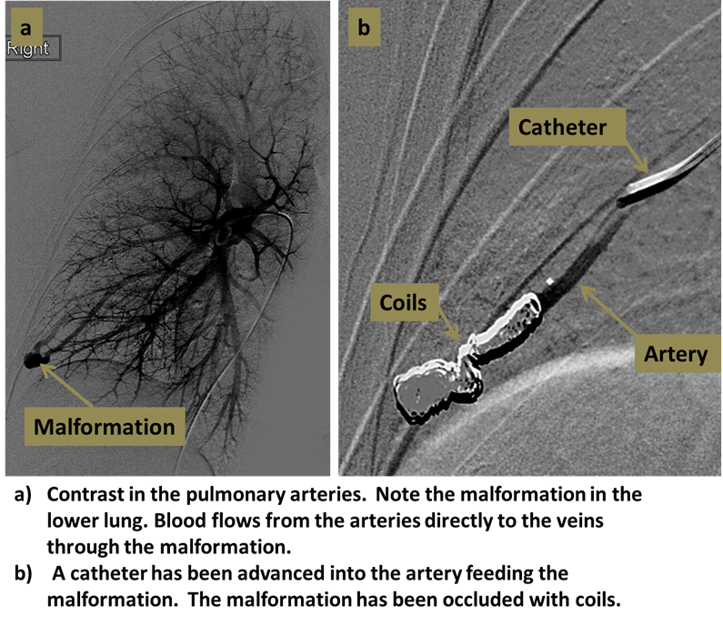 Pulmonary Angiography and Embolization - Interventional Radiology ...