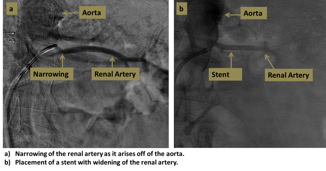 Stent Graft Placement - Interventional Radiology | UCLA Health