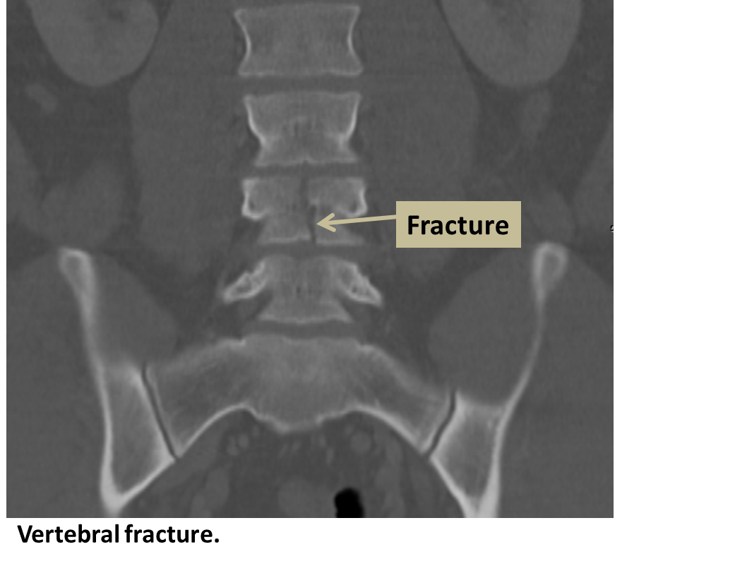 Vertebral Fracture - Interventional Radiology | UCLA Health