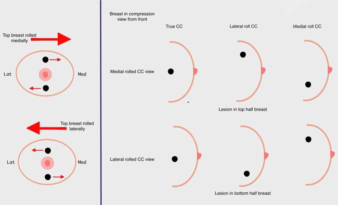 Breast Lesion Localization - Radiology | UCLA Health