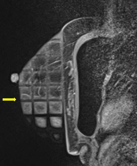 How to Perform an MRI Guided Breast Biopsy - Radiology | UCLA Health