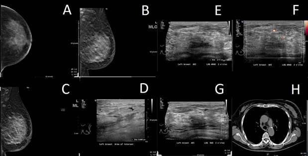 Case Metastasis to the breast from a non-breast primary cancer ...
