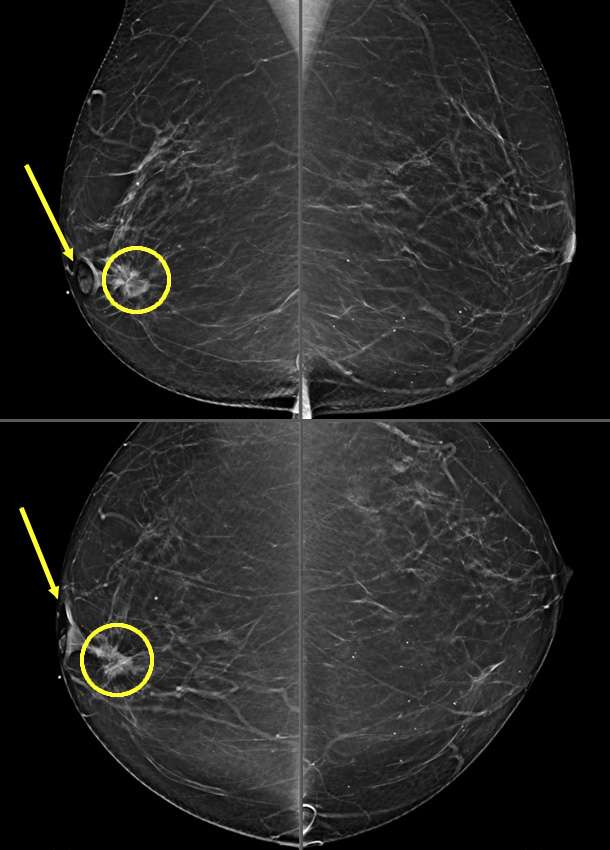 Case: Skin Retraction, Skin Thickening, and Nipple Retraction/Inversion ...