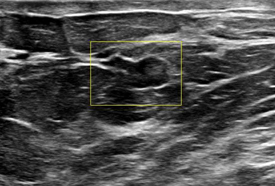 Breast Ductal Anatomy and Function - Radiology | UCLA Health