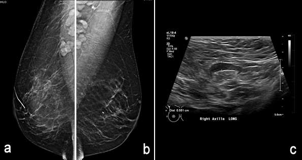 Axillary Lymphadenopathy - Radiology | UCLA Health