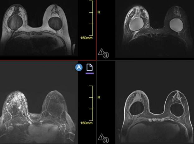 Skin Changes of the Breast - Radiology | UCLA Health