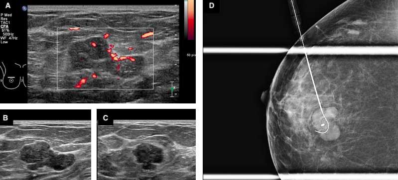 Case: Phyllodes Tumors - Radiology | UCLA Health