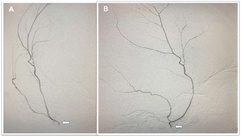 Middle Meningeal Artery Embolization for Chronic Subdural Hematoma ...