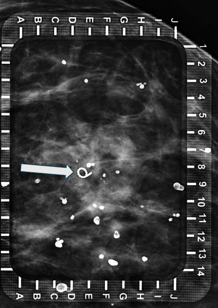 How to Perform: Mammographically Guided Wire Localizations - Radiology ...
