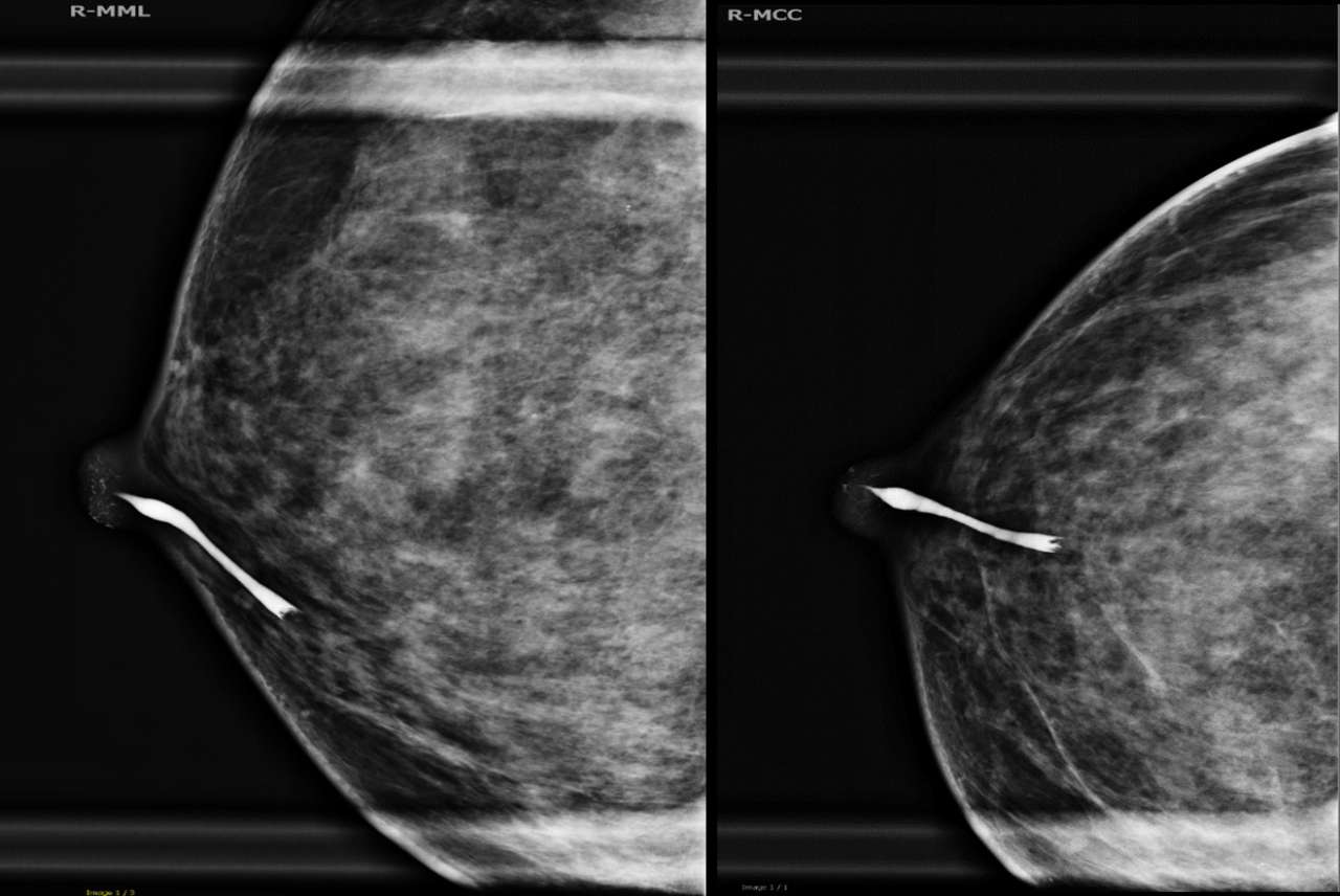 How to Perform: Ductograms - Radiology | UCLA Health
