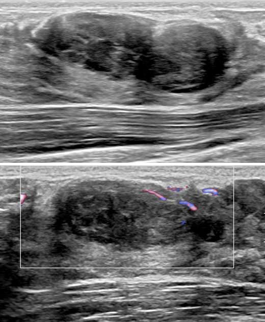 Case: Breast Imaging in Female Transgender (Male-to-Female) Patients ...