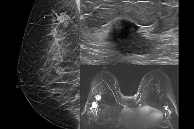 Breast Imaging Teaching Resources - Radiology | UCLA Health