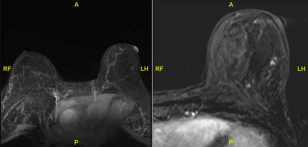 Skin Changes of the Breast - Radiology | UCLA Health