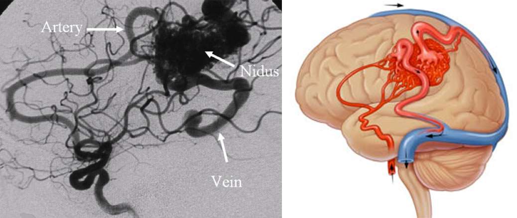 Arteriovenous Malformation - Interventional Neuroradiology | UCLA Health