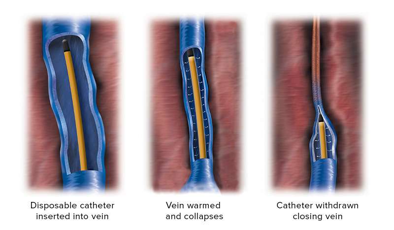 The Closure Procedure and Catheter - Venous Care | UCLA Health